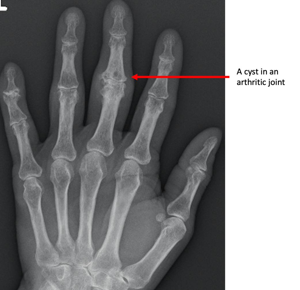 Osteoarthritis on an X-ray – Aberdeen Virtual Hand Clinic