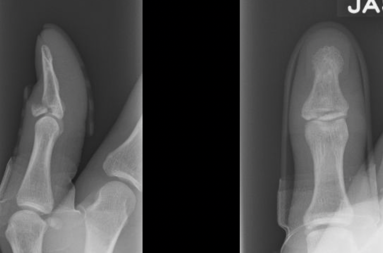 Mallet Injuries – Aberdeen Virtual Hand Clinic