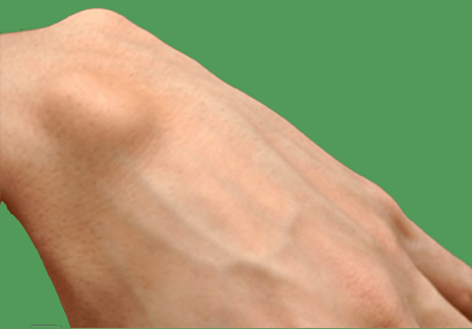 Ganglion Cysts – Aberdeen Virtual Hand Clinic