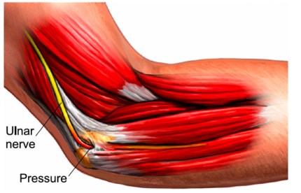 Cubital Tunnel Syndrome – Aberdeen Virtual Hand Clinic