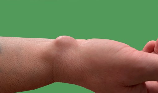 Ganglion Cysts – Aberdeen Virtual Hand Clinic
