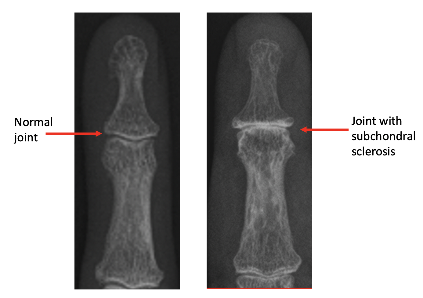 Osteoarthritis on an X-ray – Aberdeen Virtual Hand Clinic