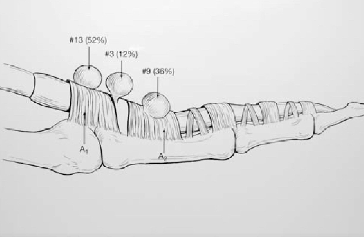 Ganglion Cysts – Aberdeen Virtual Hand Clinic